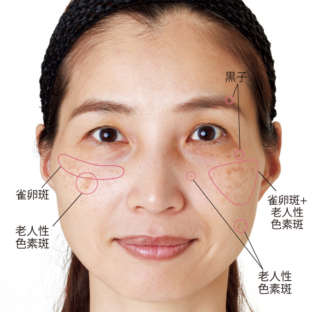 写真 (4枚目) - シミを取ると印象が激変！[ピコレーザー]40代読者が初体験レポ！ - LOCARI（ロカリ）