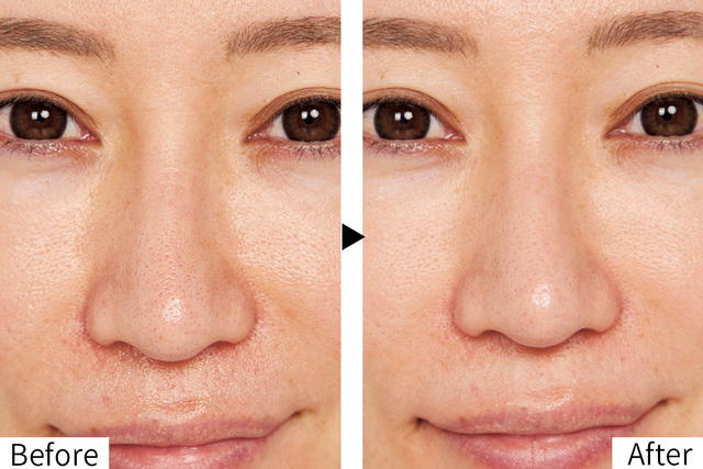 写真 (2枚目) - [Before→Afterに注目]「ふきとり美容液」でやさしく角質オフ！その実力とは？ - LOCARI（ロカリ）